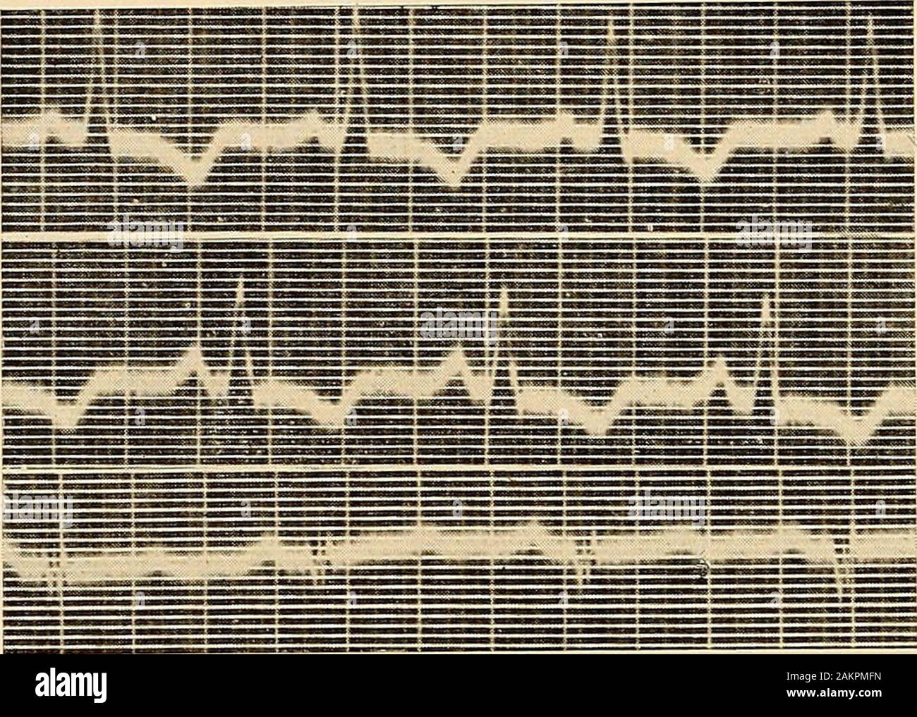 Clinical electrocardiography . Fig. 110.—Negative T wave in Derivation ...