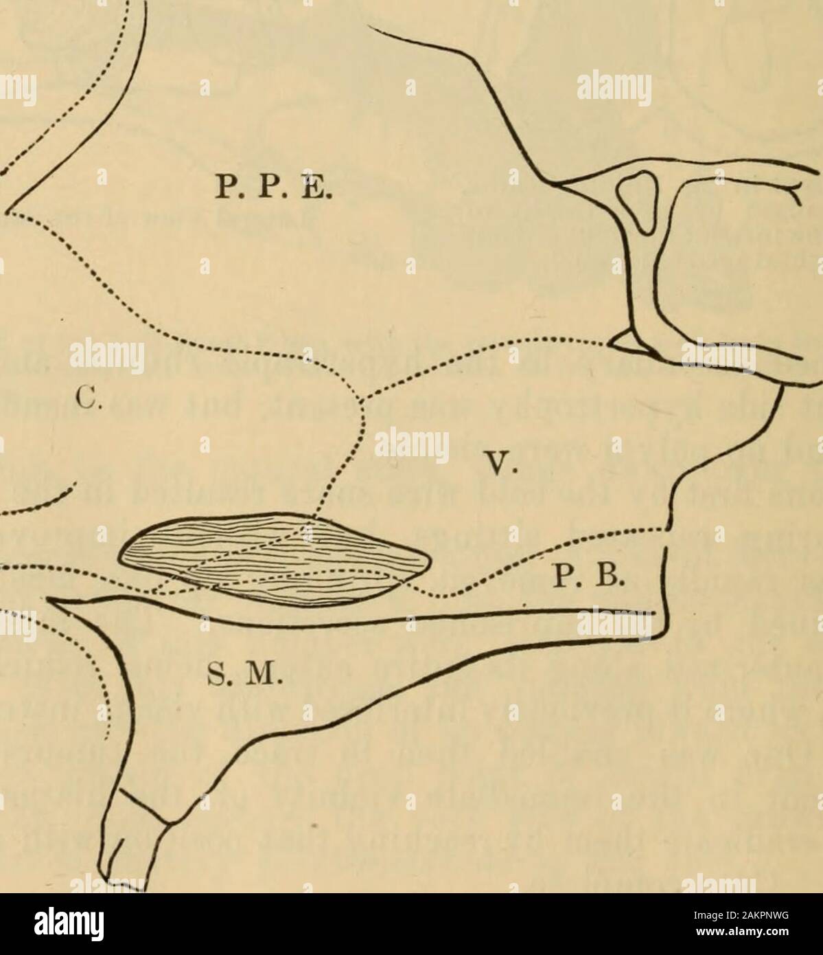 An American text-book of the diseases of children .. . Single Polypus ...