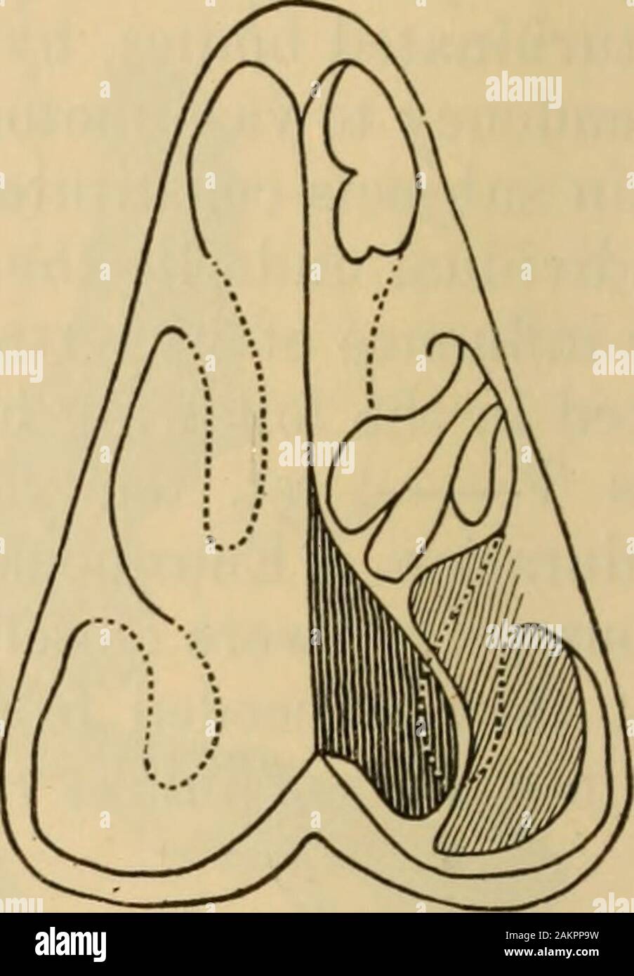 An American text-book of the diseases of children .. . Single Polypus ...