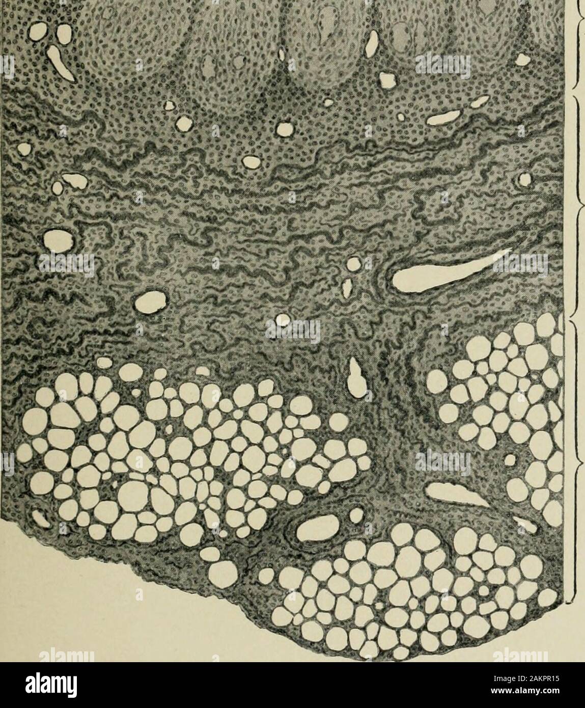 Tuberculous abscess hi-res stock photography and images - Alamy