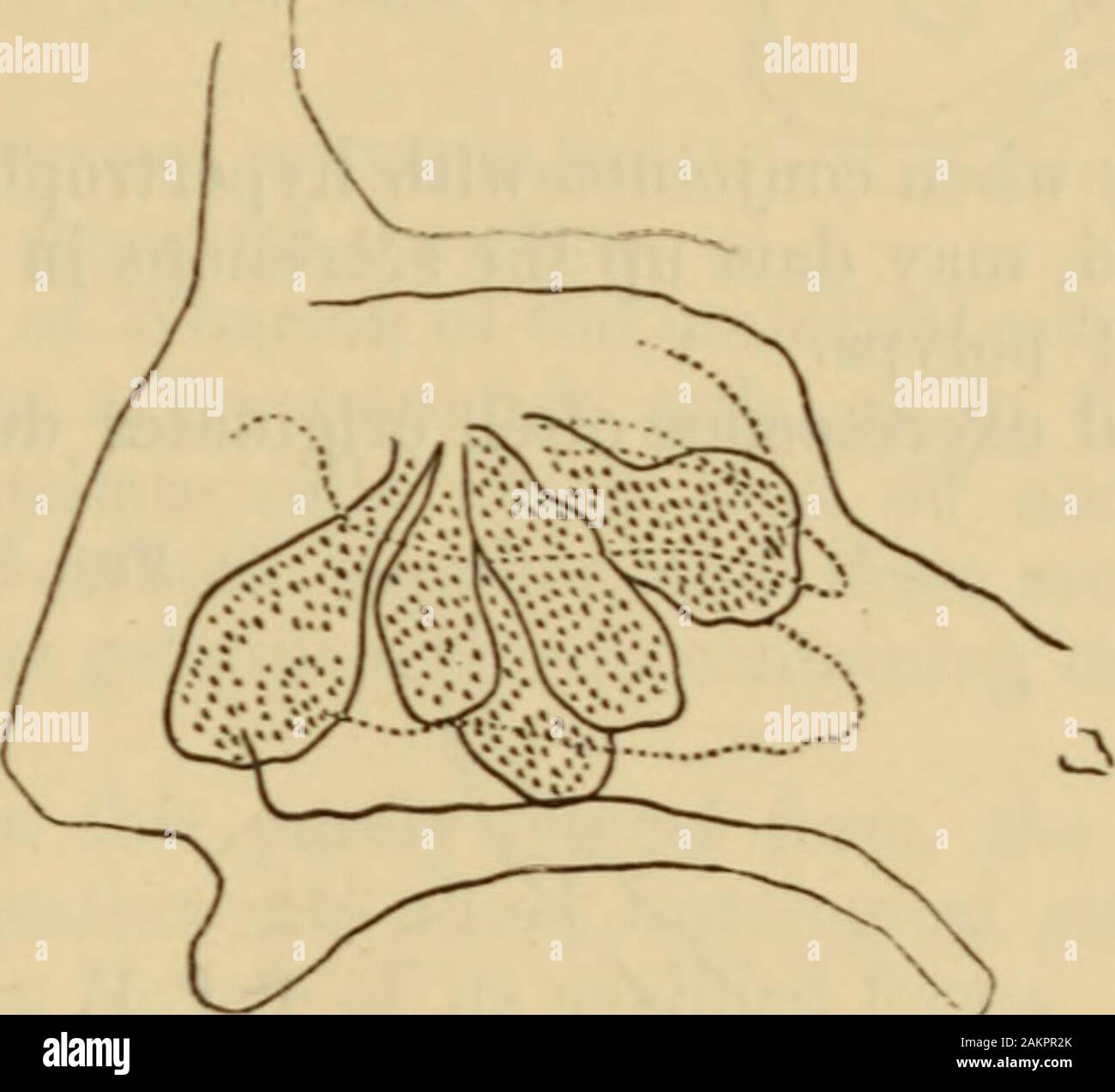 An American text-book of the diseases of children .. . Fig. 5. Polypi ...