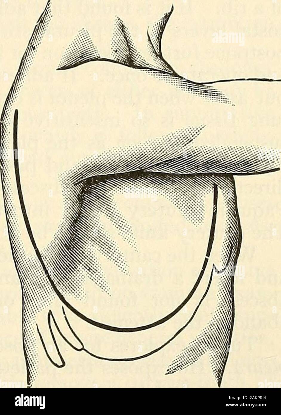 Modern surgery, general and operative . so large as that caused by ...