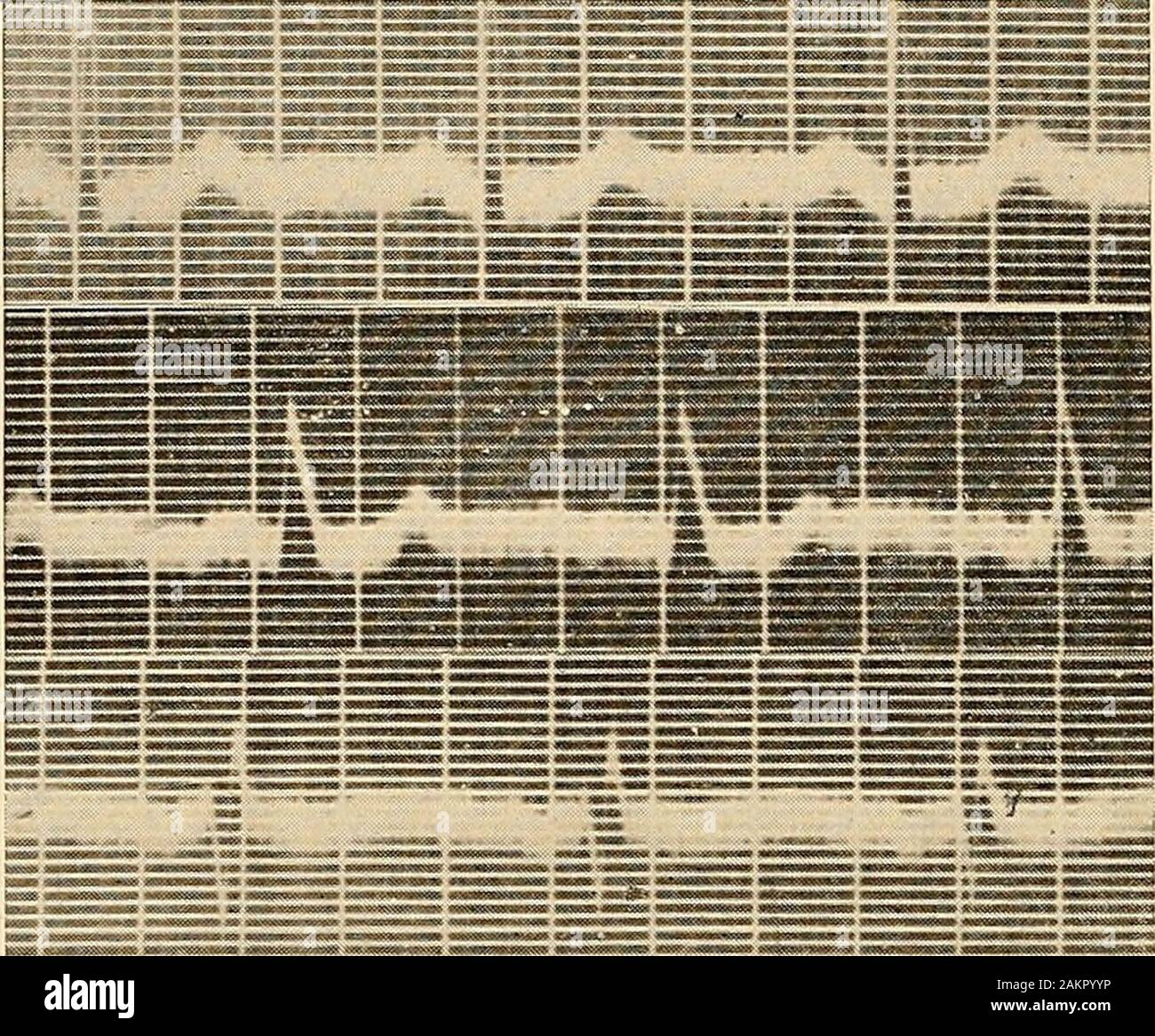 Clinical electrocardiography . Fig. 94.—Slurred Q R S complexes in ...