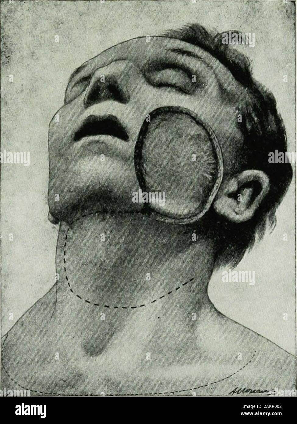 Suppurating hi-res stock photography and images - Alamy