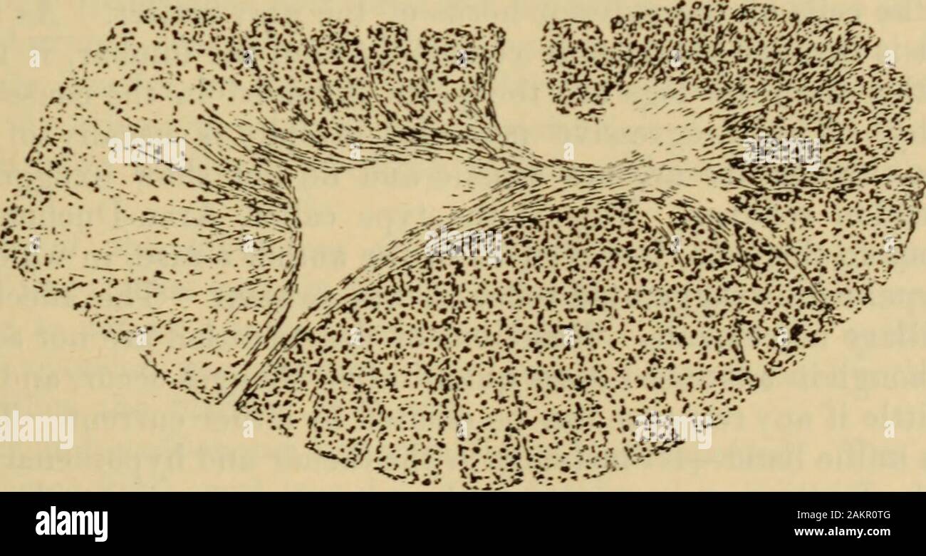 Syringomyelia Cross Section