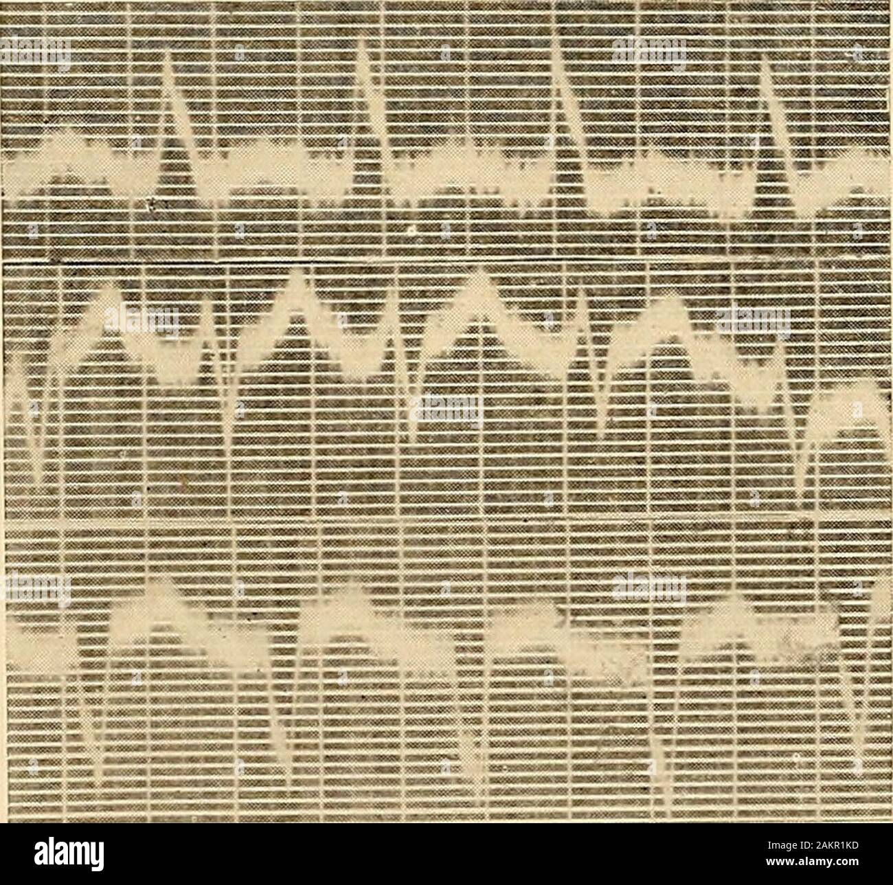 Clinical electrocardiography . Fig. 89.—Aberrant Q R S complexes all ...