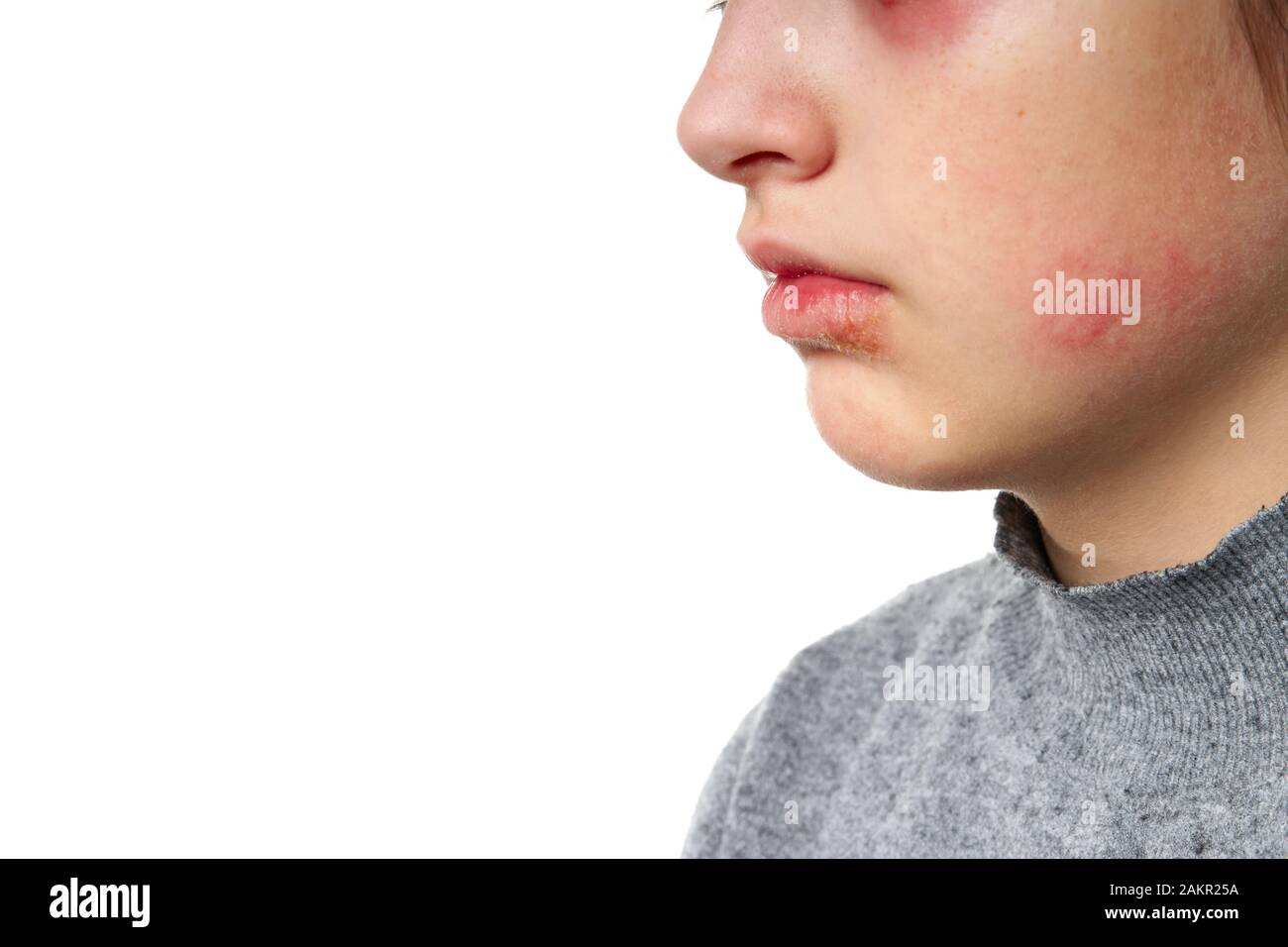Allergic reaction, skin rash, close view portrait of a girl's face ...