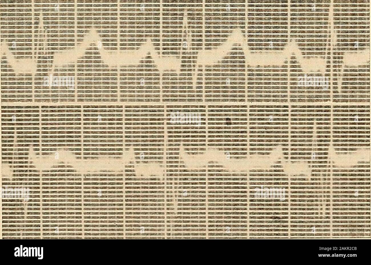 Clinical electrocardiography . Fig. 88.—Aberrant QRS complexes all ...