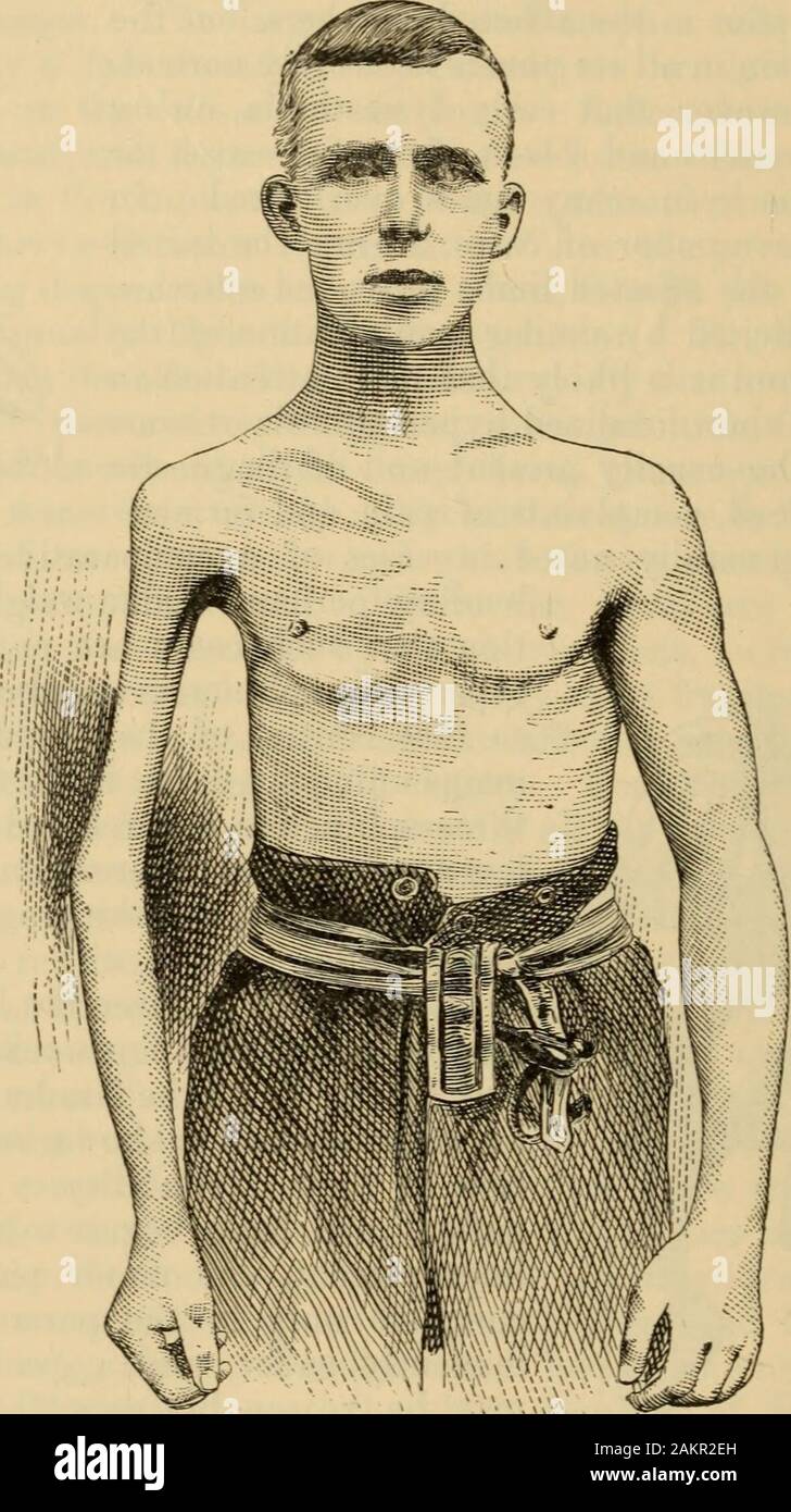 Atrophied arm hi-res stock photography and images - Alamy