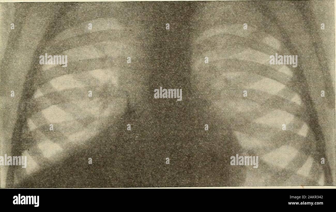Obstructed bronchus hi-res stock photography and images - Alamy