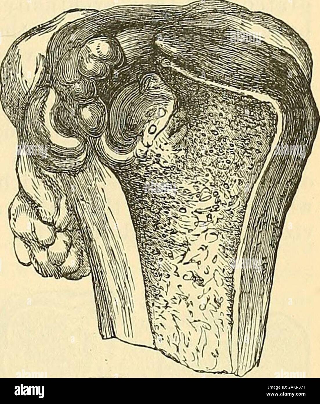 Caseation High Resolution Stock Photography and Images - Alamy