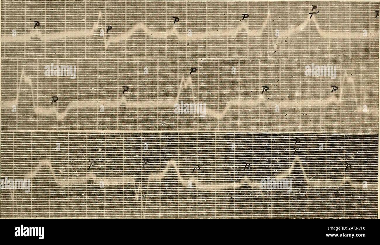 Clinical electrocardiography . iologic conditions were chronic myo ...