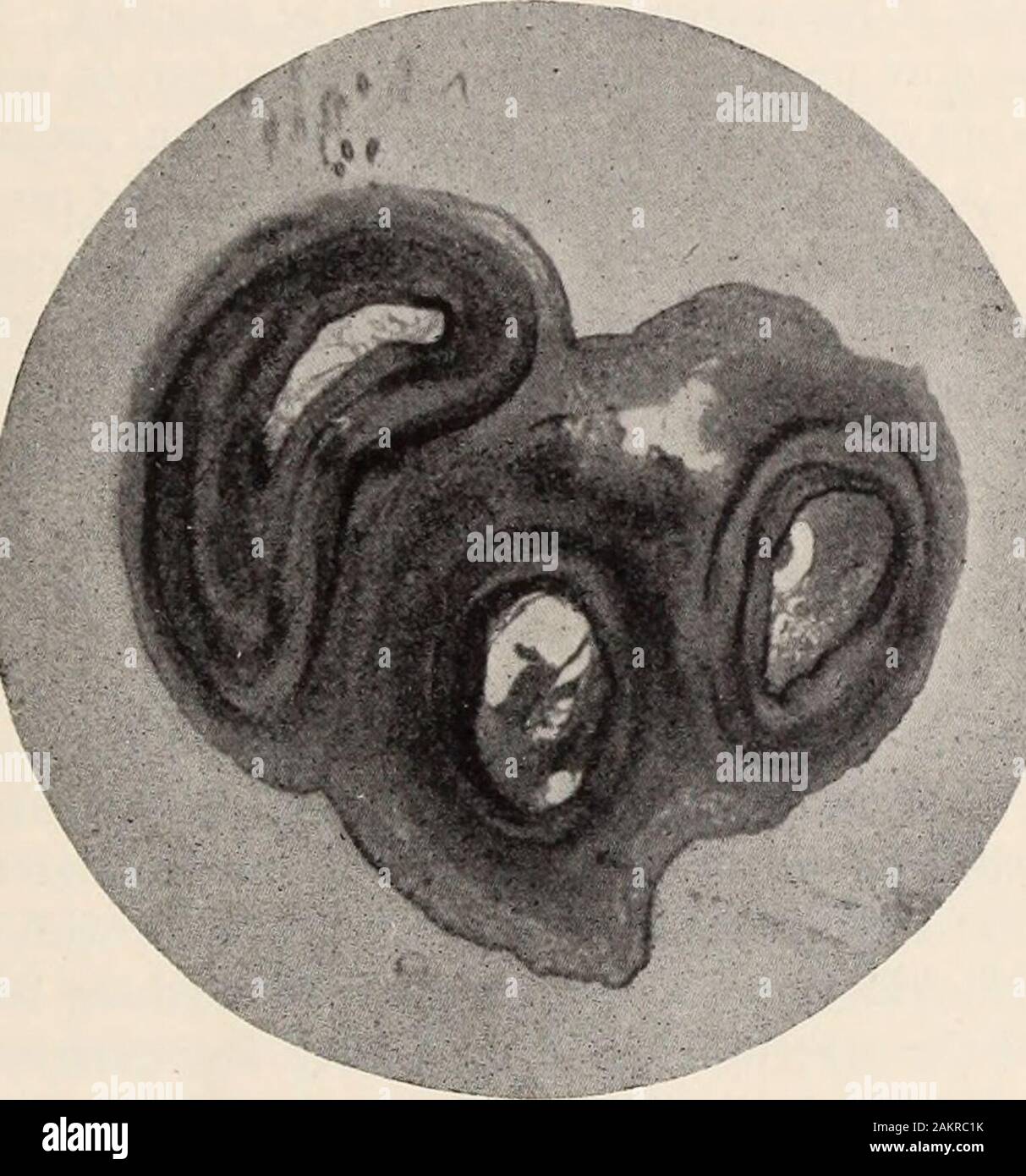 Hereditary syphilis hi-res stock photography and images - Alamy