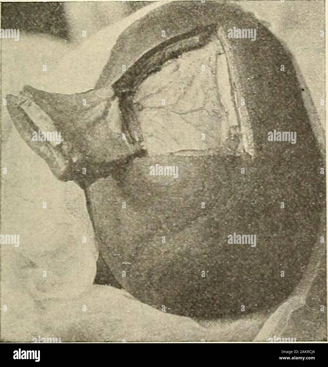 Modern surgery, general and operative . Fig. 530.—Hudsons modified ...