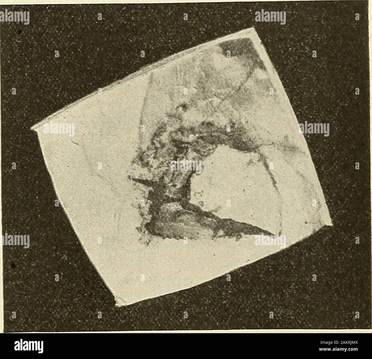 Modern surgery, general and operative . e frequent in the aged.Usuallv ...