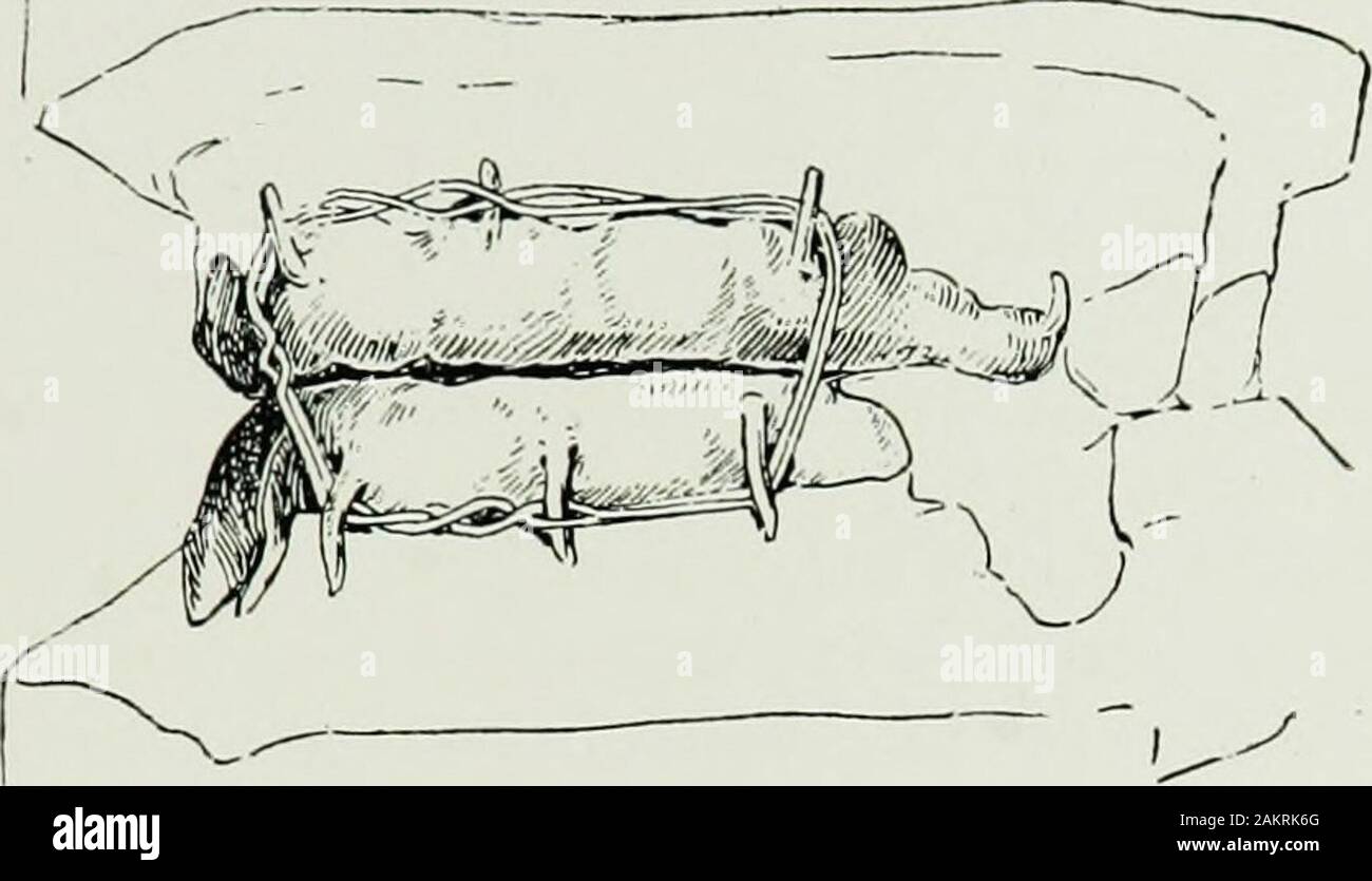 Traction aid hi-res stock photography and images - Alamy