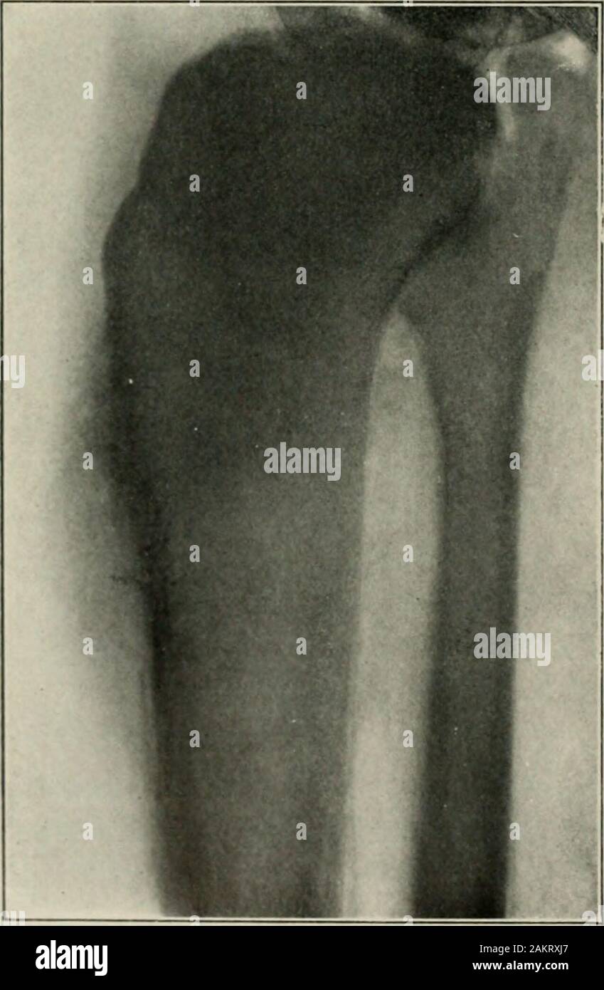 Sarcoma leg hi-res stock photography and images - Alamy