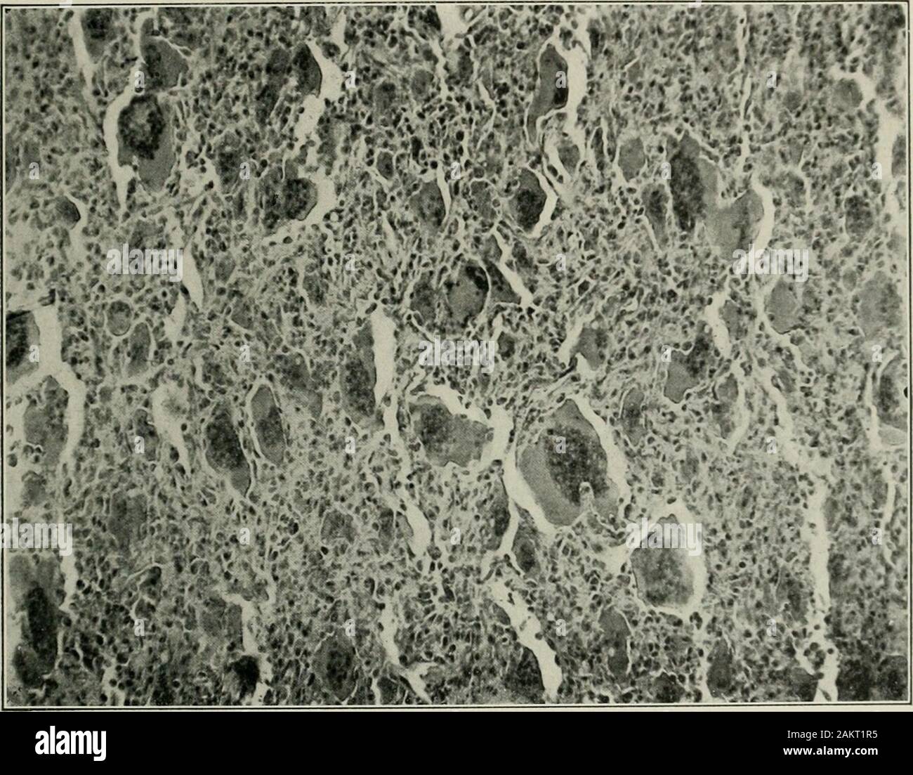 Hemorrhagic cysts hi-res stock photography and images - Alamy