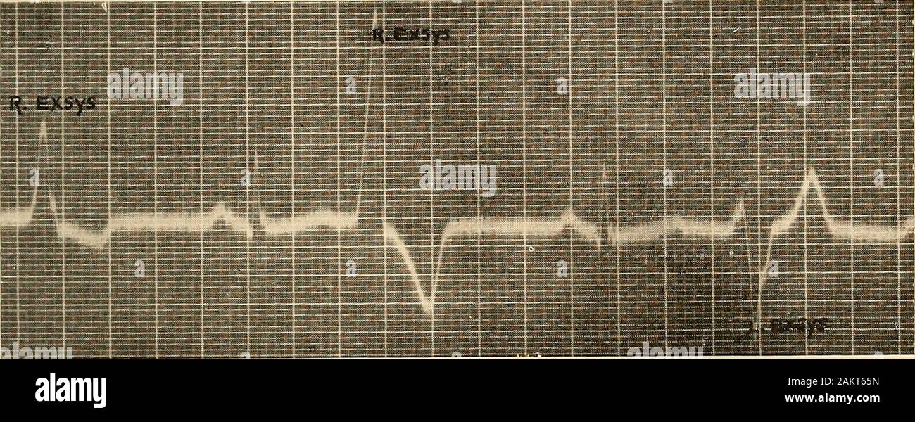 Premature ventricular contractions hi-res stock photography and images ...