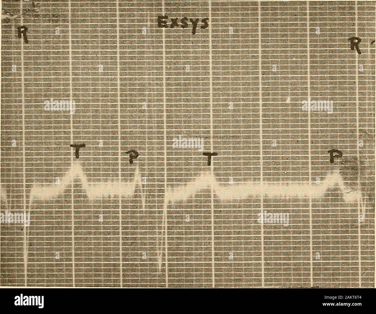 Clinical electrocardiography . Fig. 28.—Nodal premature contraction. P ...