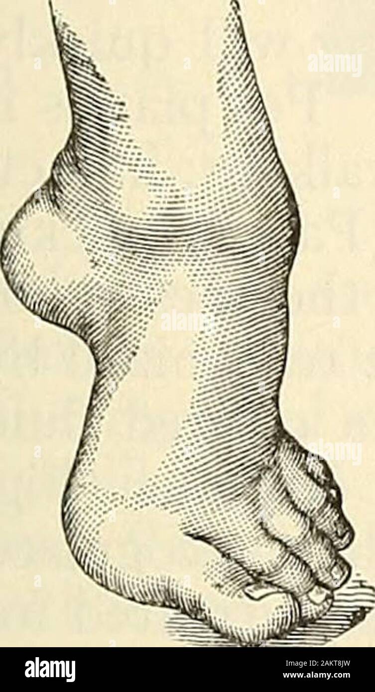 Talipes valgus hi-res stock photography and images - Alamy