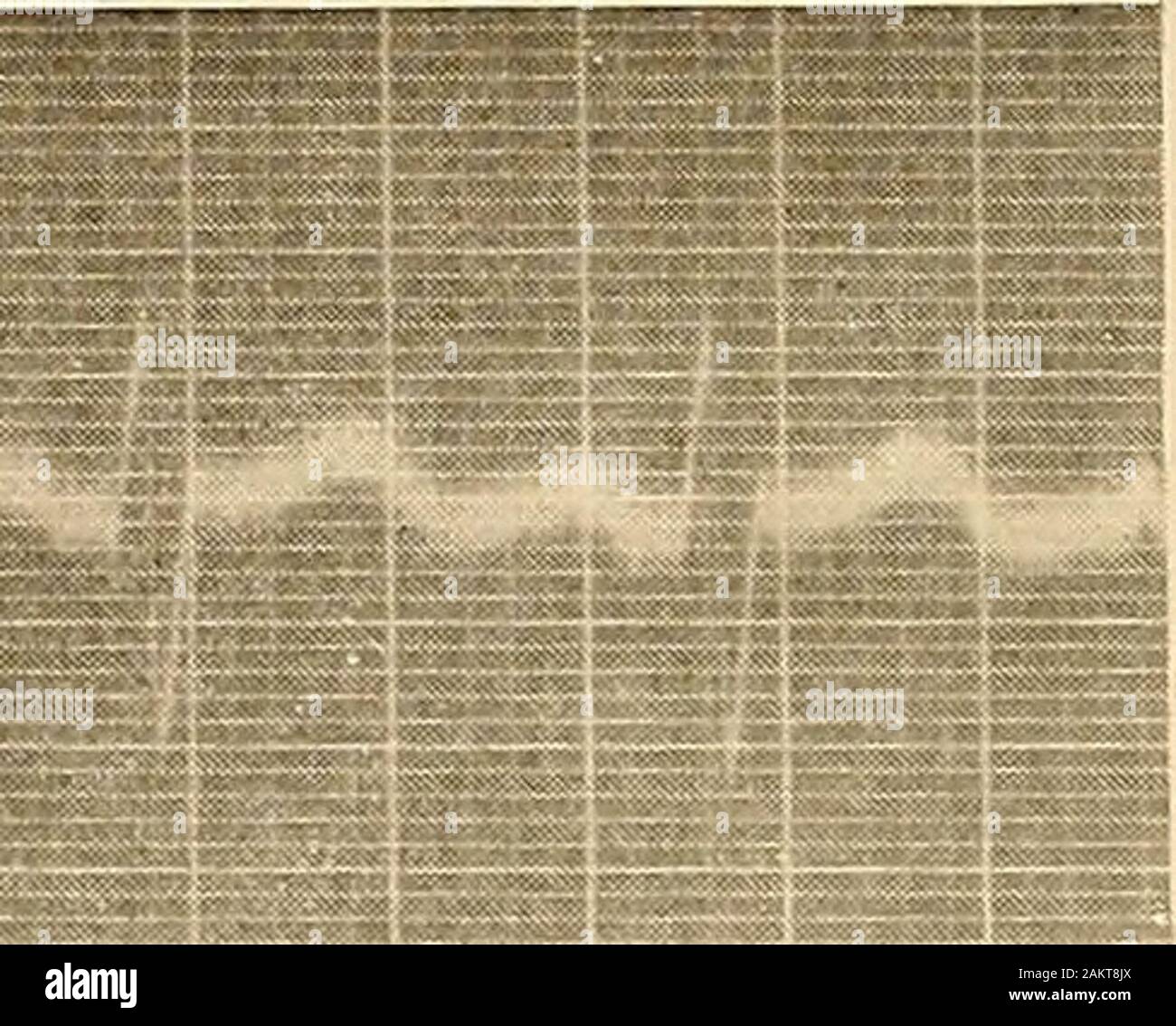 Clinical electrocardiography . Fig. 22.—Electrocardiogram in Derivation ...