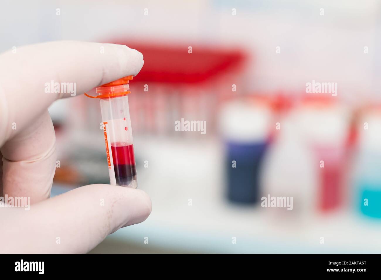 hemolyzed blood sample in the hand of scientist Stock Photo - Alamy