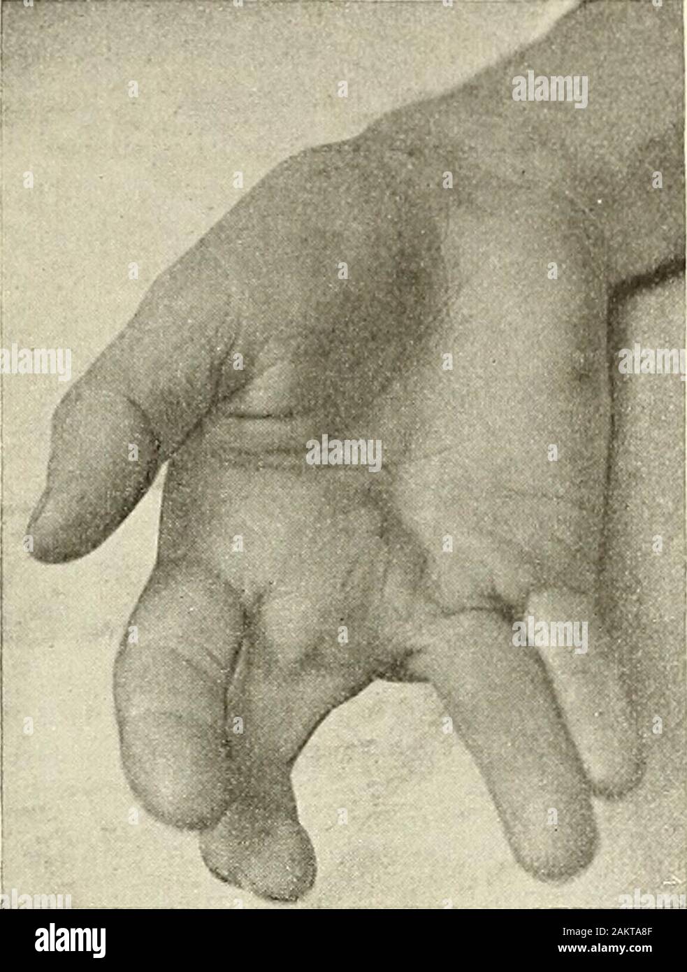 Skin traction hi-res stock photography and images - Alamy