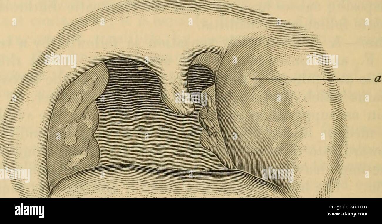 Cold abscess hi-res stock photography and images - Alamy