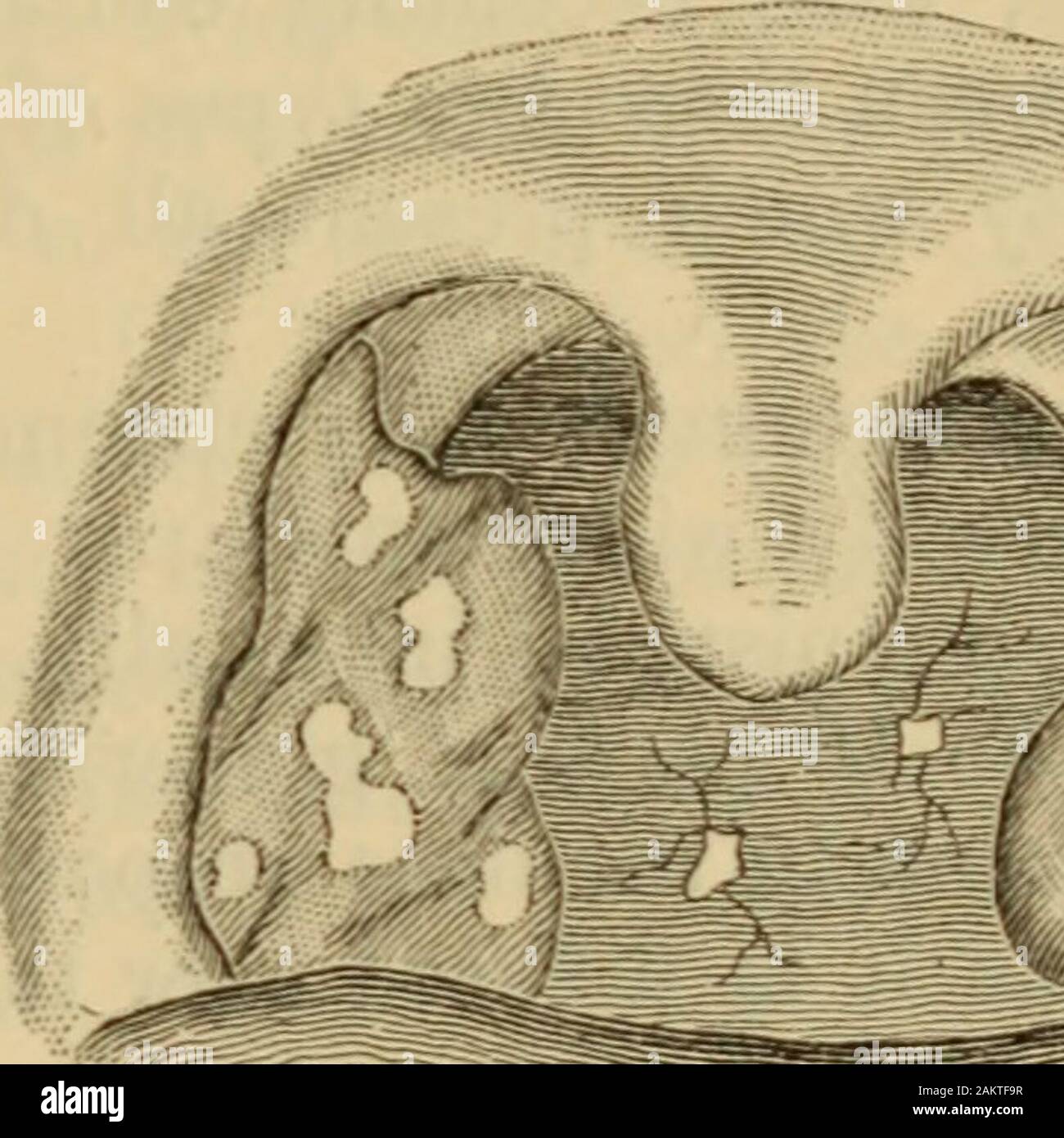 Pharynx diphtheria hi-res stock photography and images - Alamy