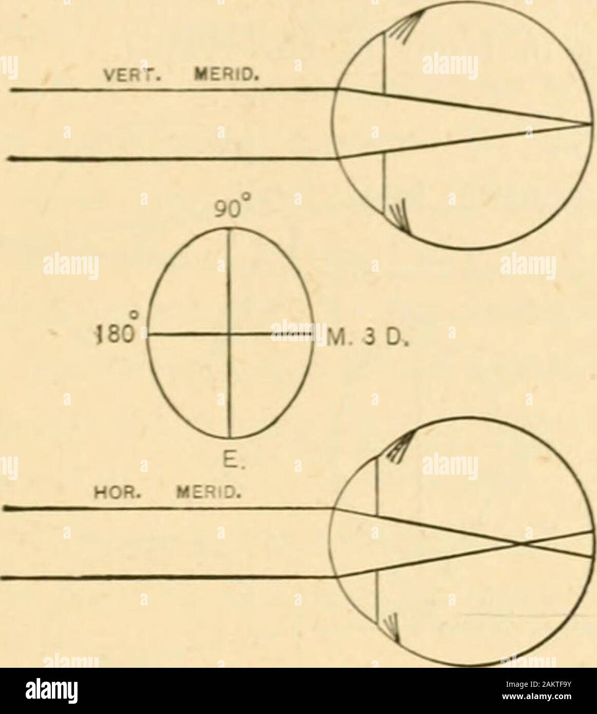 Myopi hi-res stock photography and images - Alamy