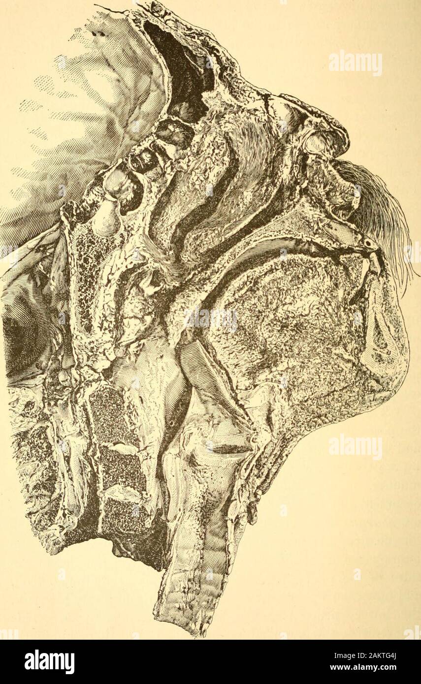 Diseases of the nose and throat; a text-book for students and ...