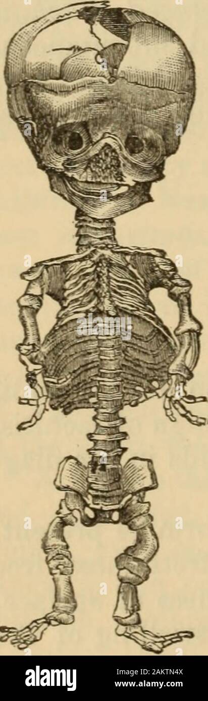 Rachitic rosary hi-res stock photography and images - Alamy