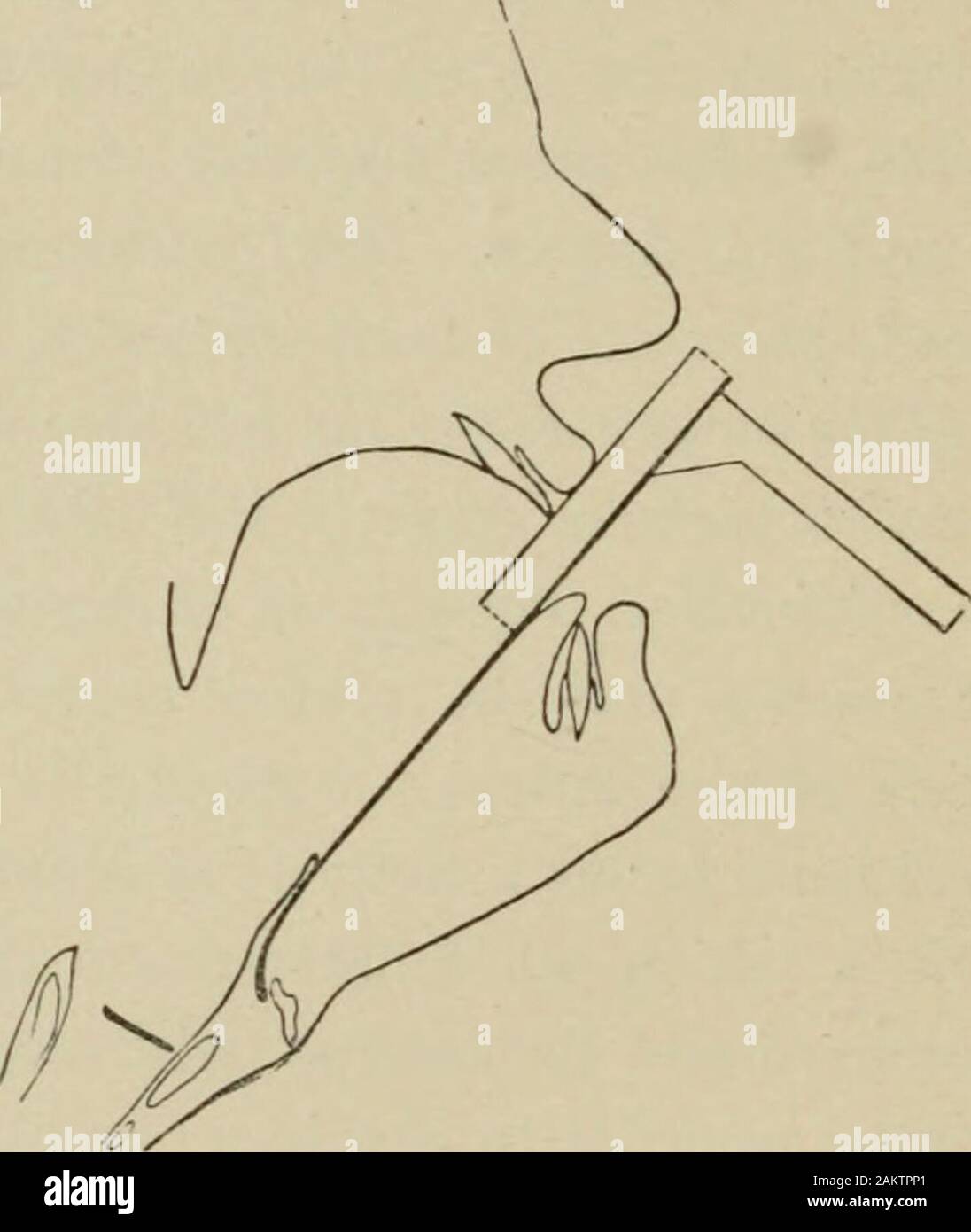 Laryngeal tube hi-res stock photography and images - Alamy