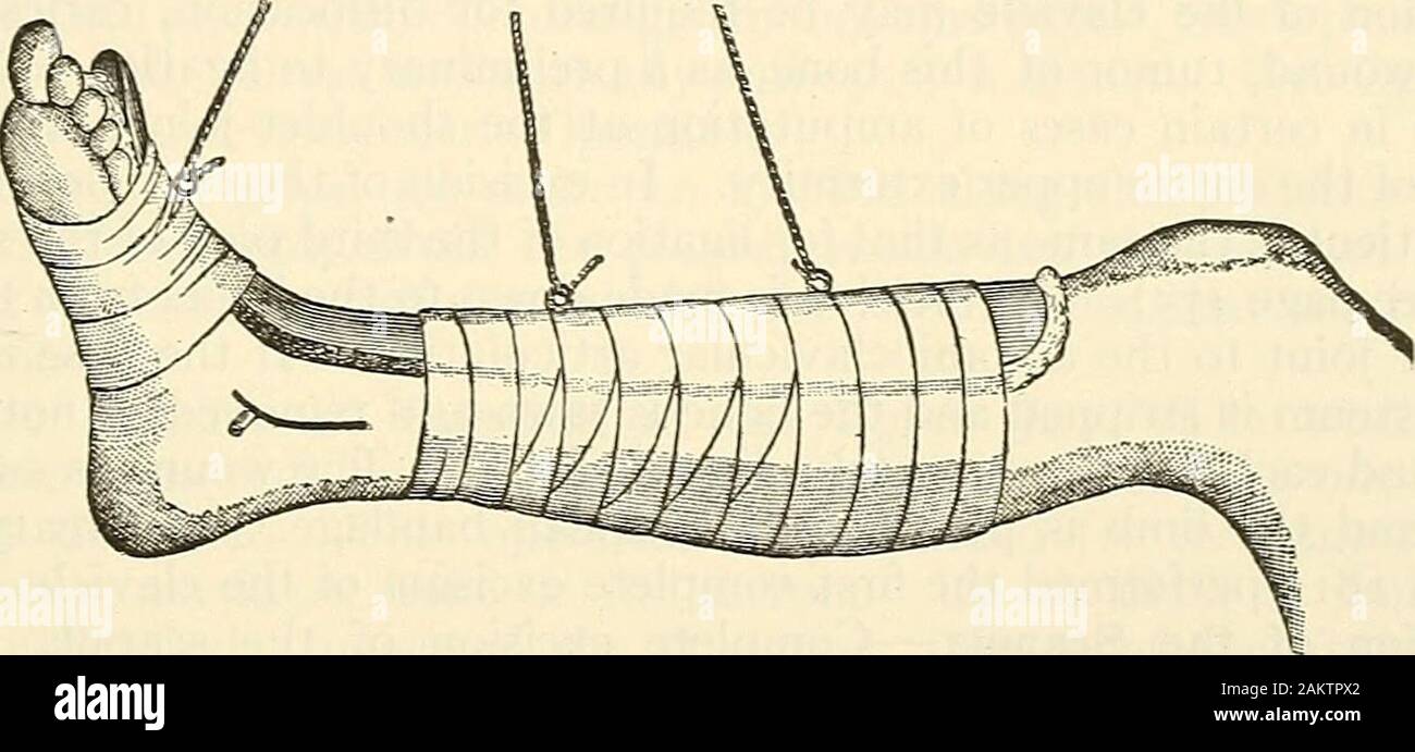 Modern surgery, general and operative . Tnes amputation inthe event of ...