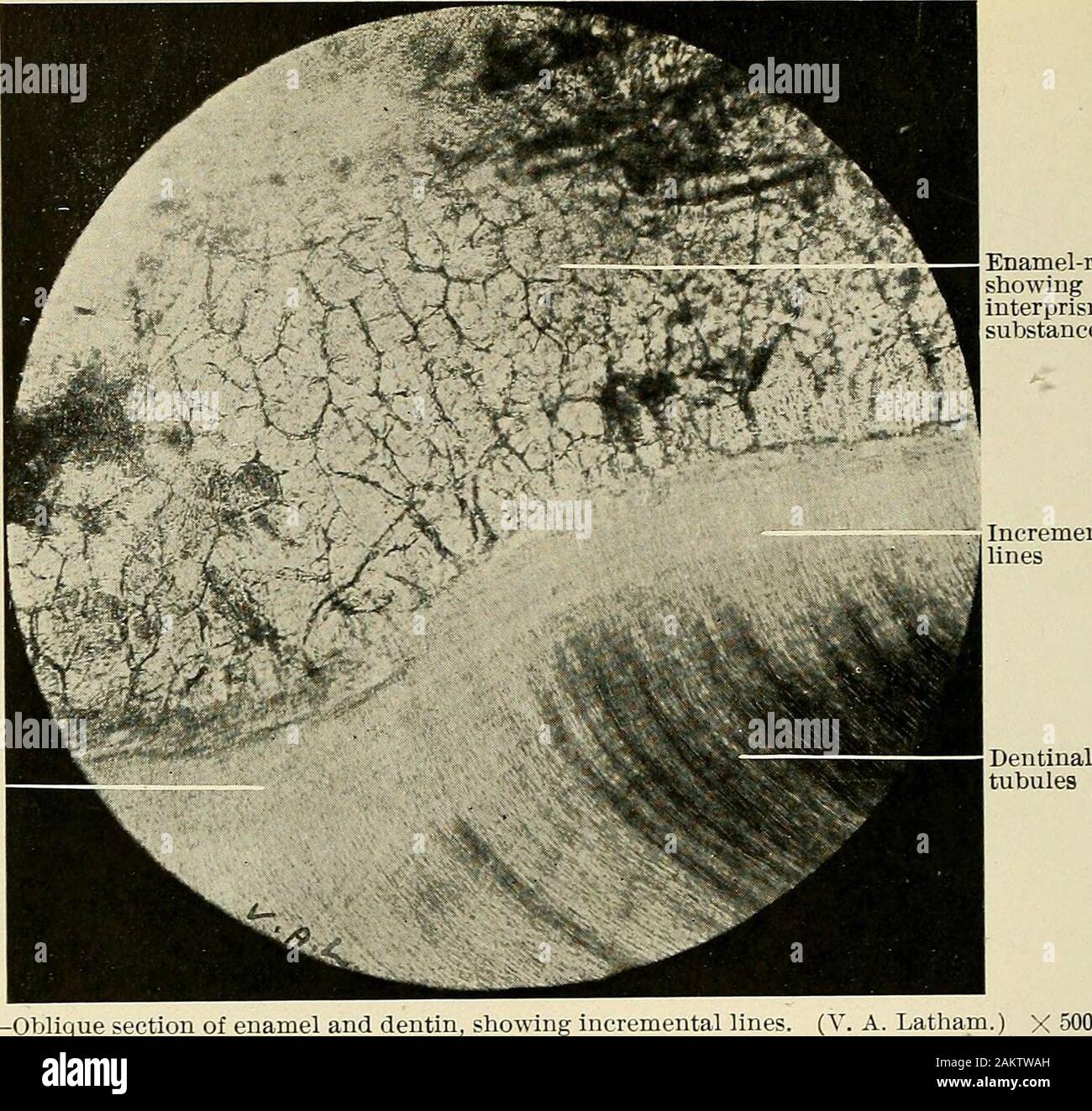 Principles and practice of operative dentistry . Interglobulard spaces ...