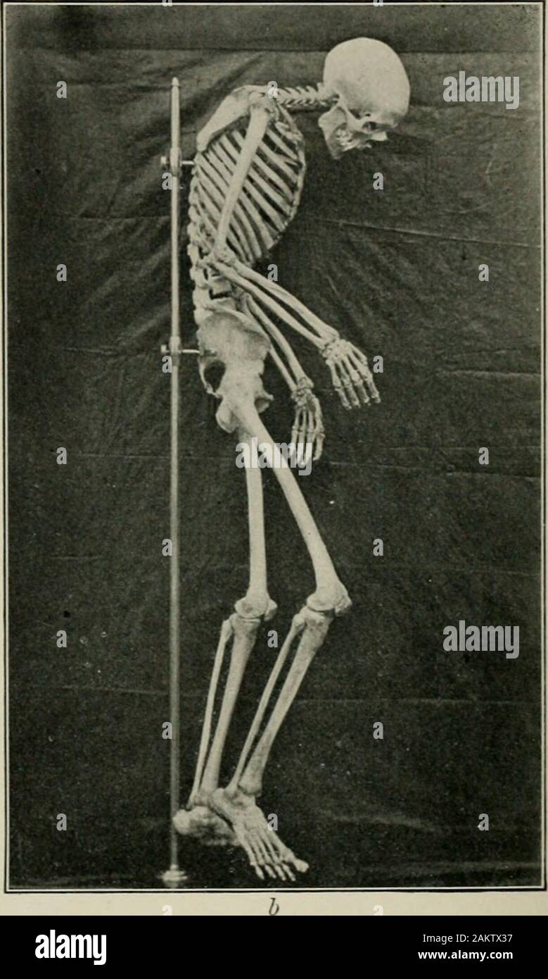 Osteophytes hi-res stock photography and images - Alamy