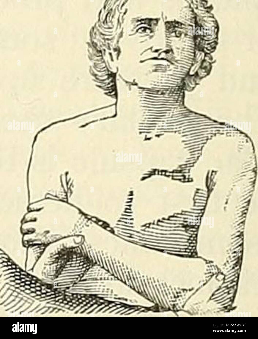 Modern surgery, general and operative . Fig. 402.—Kochers method of ...