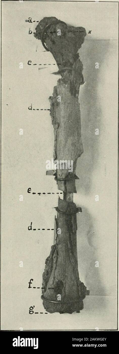 Linea aspera of femur hi-res stock photography and images - Alamy