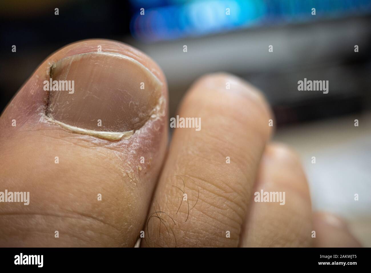 the pathologically changed nail bed of a big toe Stock Photo - Alamy