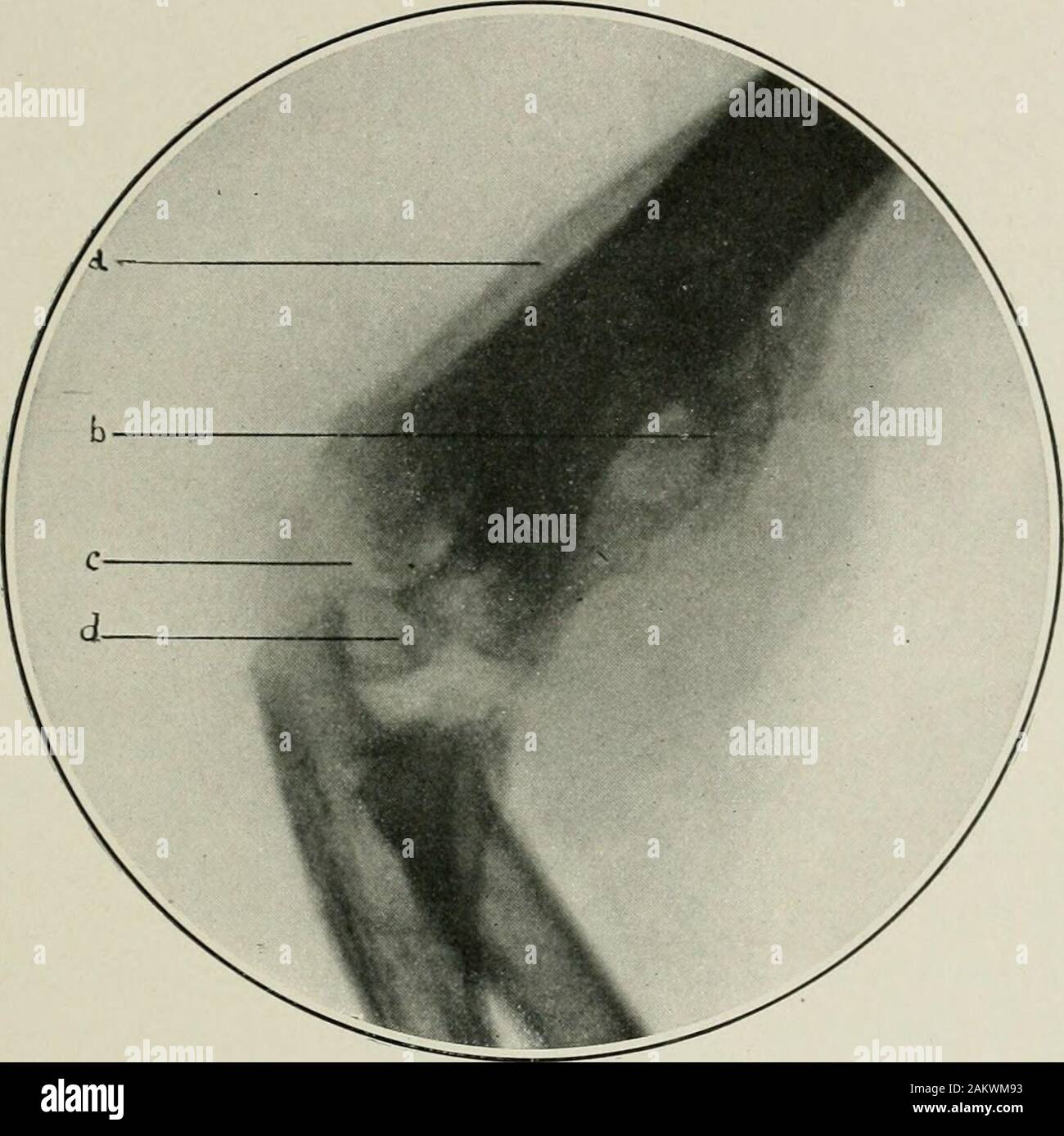 Periostitis hi-res stock photography and images - Alamy