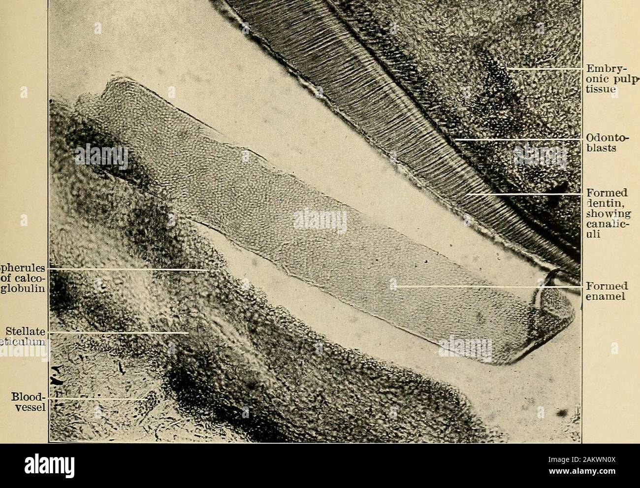 Principles and practice of operative dentistry . Fig. 130.—Dentinal ...