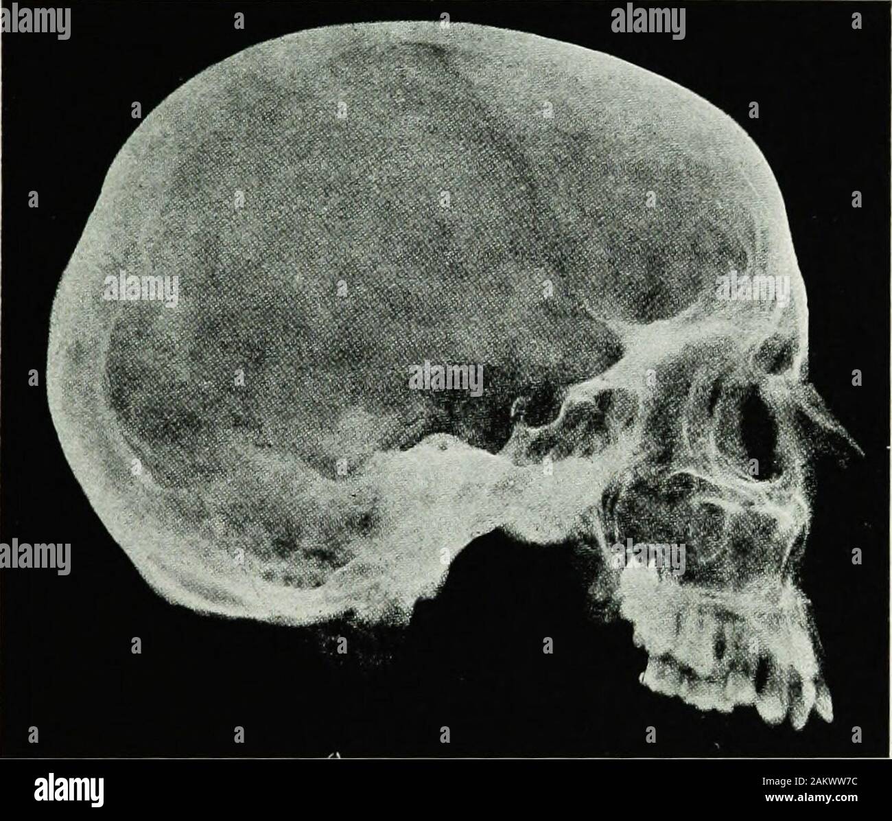 Temporal fascia hi-res stock photography and images - Alamy