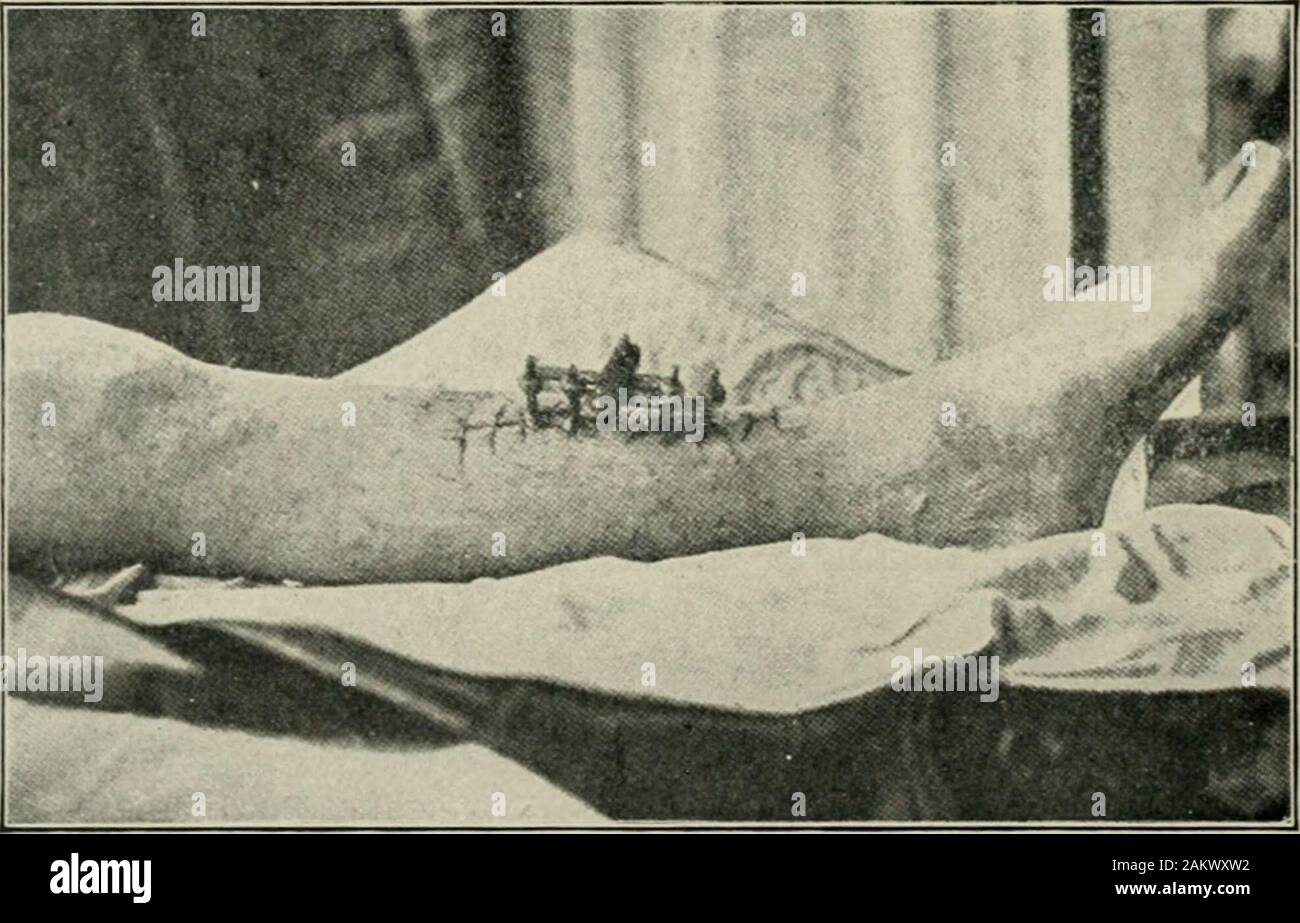 Bone clamp hi-res stock photography and images - Alamy