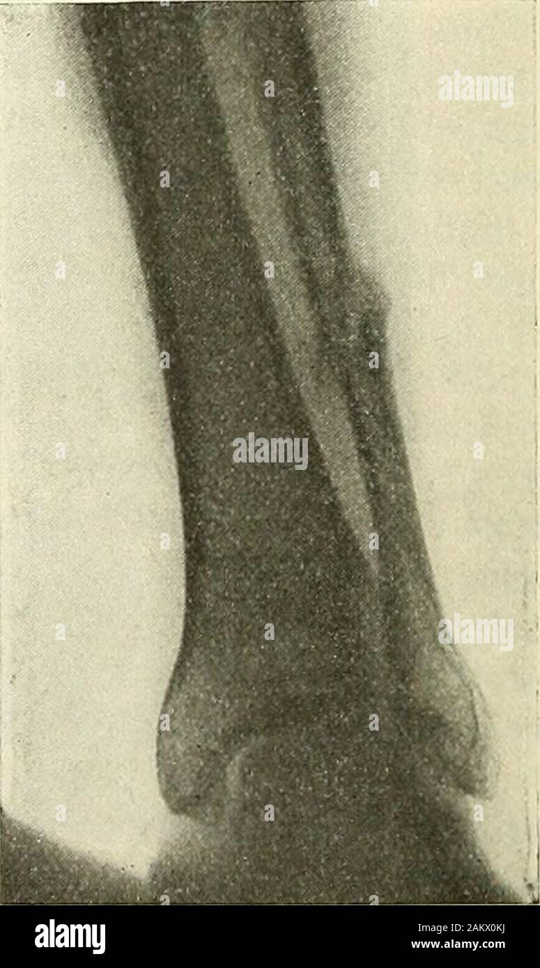 Modern surgery, general and operative . Fig. 377.—Potts fracture ...