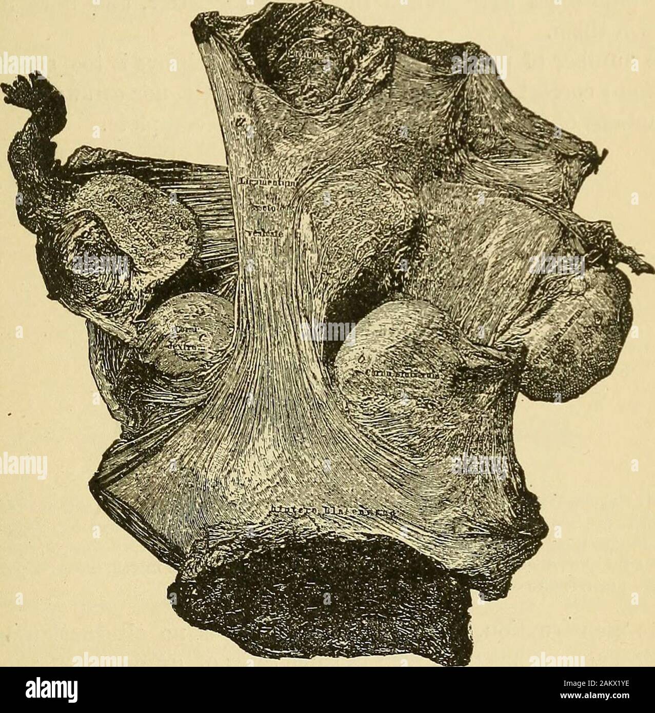 Cyclopædia of obstetrics and gynecology . Fig. 41.—Bouble Uterus with ...