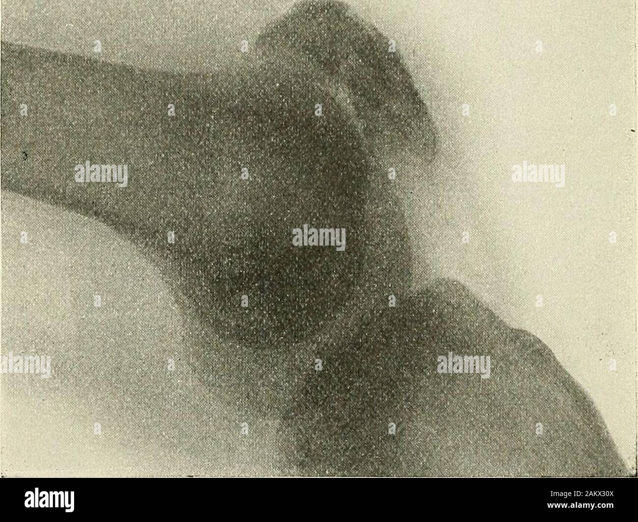 Compound bone fracture hi-res stock photography and images - Alamy