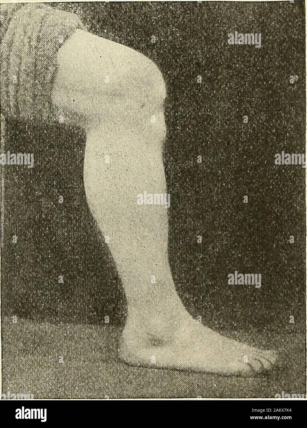 Modern surgery, general and operative . leg bends to-ward the injury ...