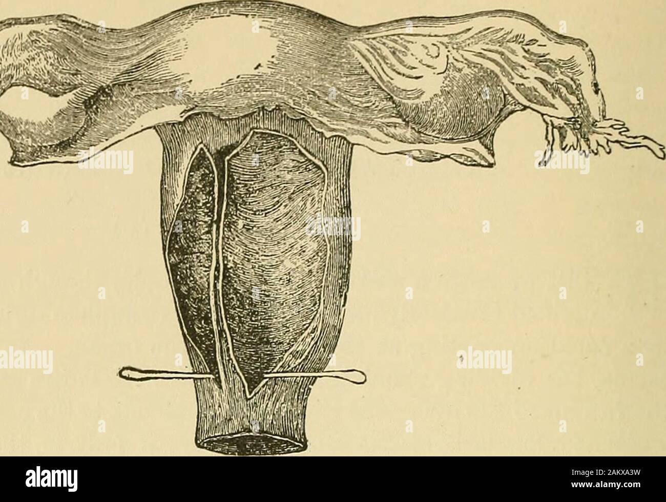 Perforated uterus hi-res stock photography and images - Alamy