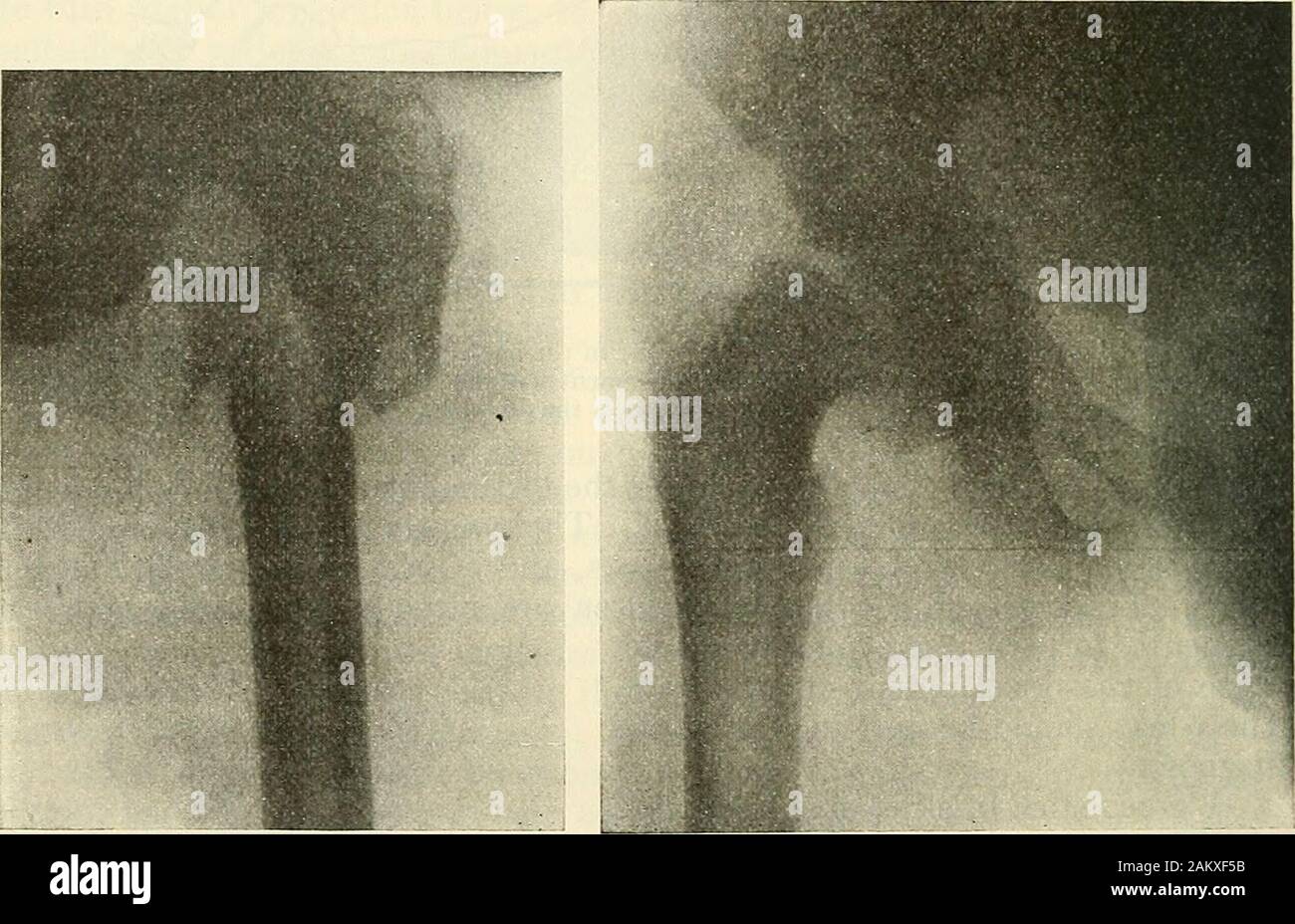 Femoral osteotomy hi-res stock photography and images - Alamy